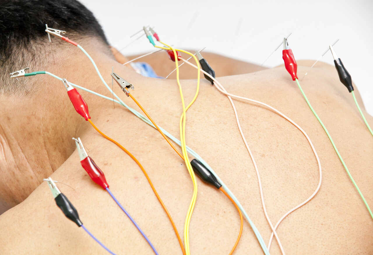 Relieve the Pressure: How Acupuncture Treats Pinched Nerves Effectively